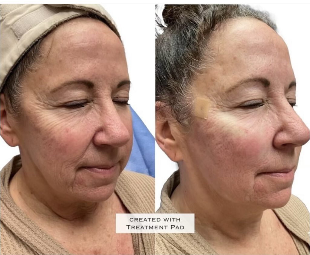 PDO Threads Archives | Radiant Skin Radiant Skin