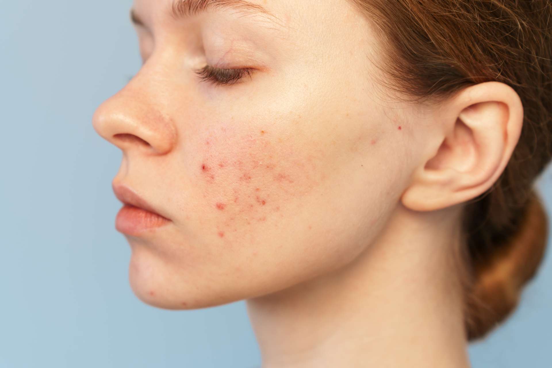 What Are the Best Facials for Acne-Prone Skin? | Radiant Skin Radiant Skin